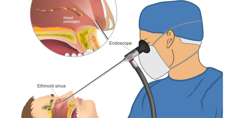 Endoscopic Sinus Surgery: What to Know About the Procedure – Health By Doc